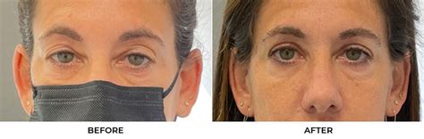 Upper Blepharoplasty Archives Dr Mahsa Sohrab