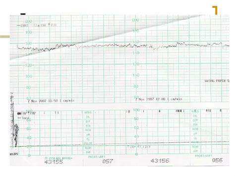Cardiotocography Ctg Ppt