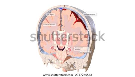 79 En La Categoría Cerebral Herniation De Fotos E Imágenes De Stock