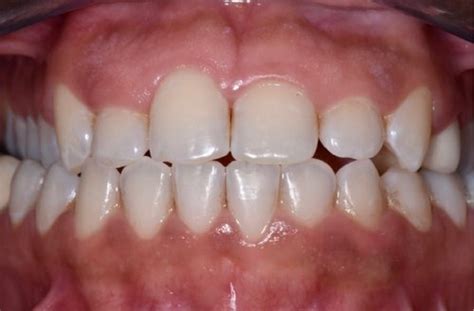Esthetic Crown Lengthening Bucks County Periodontics