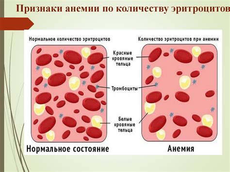 Сестринская деятельность при анемии у детей презентация онлайн