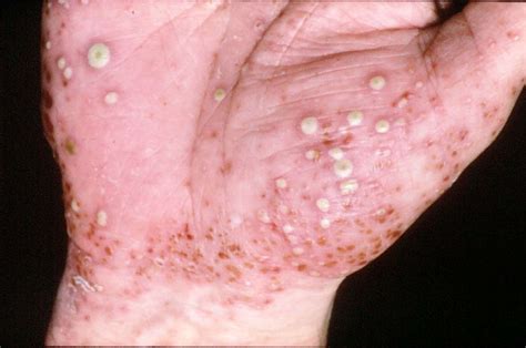 7 Types Of Psoriasis Diagnosis And Treatment Options