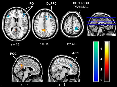 Regression Analysis Whole Brain Correlation Maps Between Brain