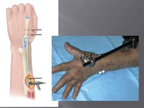 Distal End Radius Fracture Pptx