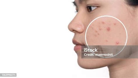 줌 원에 여드름 피부를 가진 젊은 여자의 닫습니다 동그라미를 가진 아시아 여성의 얼굴은 여드름 치료 전후에 문제가 있는 피부를 보여줍니다 여드름에 대한 스톡 사진 및 기타