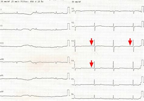 Interatrial Block Ecg Book