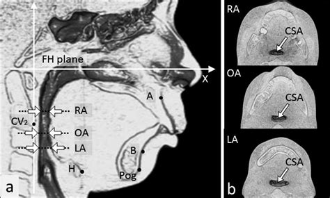 Morphological Measurement Of Cephalometric Landmarks And Pharyngeal