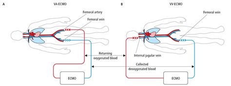 Pulsatile Ecmo At Dorothy Leasure Blog