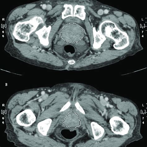 The Measurement Of The Prostate Volume Using Auto Contour Measurement Download Scientific Diagram