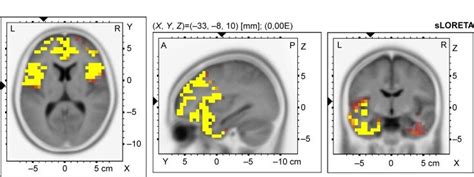 Voxel Wise Statistical Nonparametric Map Of SLORETA Images In OCD