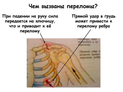 Оказание первой помощи при ушибах вывихах суставов и переломах костей