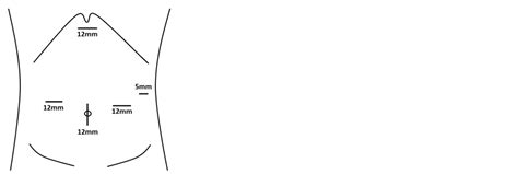 Totally Laparoscopic Total Gastrectomy With D2 Lymphadenectomy For Advanced Gastric Cancer