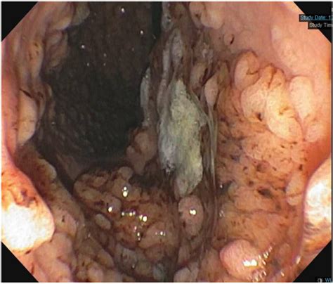 Ercp Showing Marked Bile Duct Inflammation Download Scientific Diagram