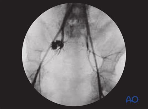 Angio Embolization For Acute Pelvic Treatment
