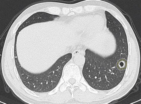 A 25 Year Old Male With Aids Complicated By Cryptococcus Pneumonia