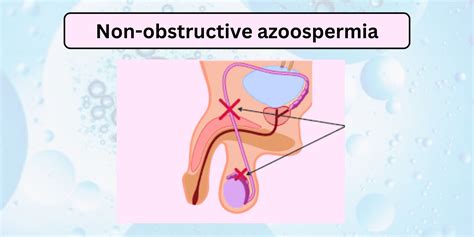 Non Obstructive Azoospermia Clinicspots