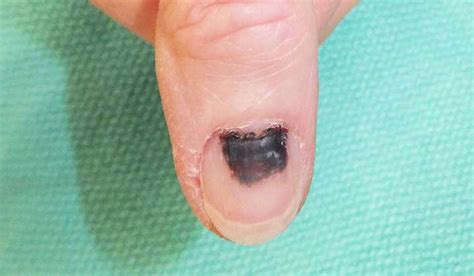 Subungual Hematoma Vs Melanoma Subungual Haemorrhage