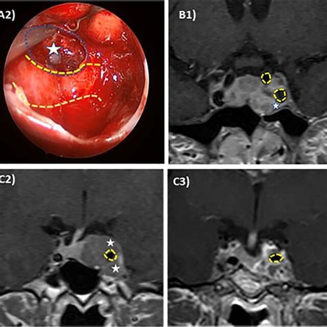Hardy Wilson And Knosp Classifications Hardy Wilson Classification Download Scientific Diagram