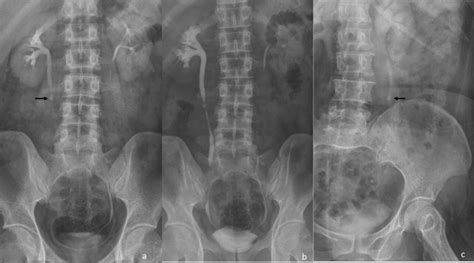 Conventional Uroradiology With Excretory Urography A Forgotten Art Pmc