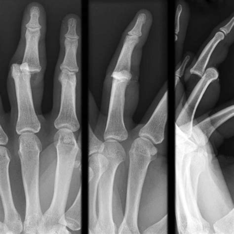 Interphalangeal Joint