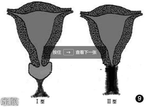 阴道闭锁是怎么回事如何治疗 蜜颜优惠