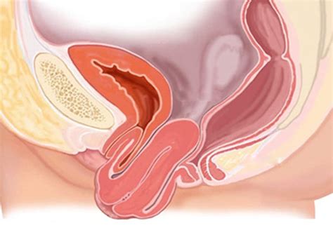 Prolapso De Vejiga Vs Prolapso Uterino