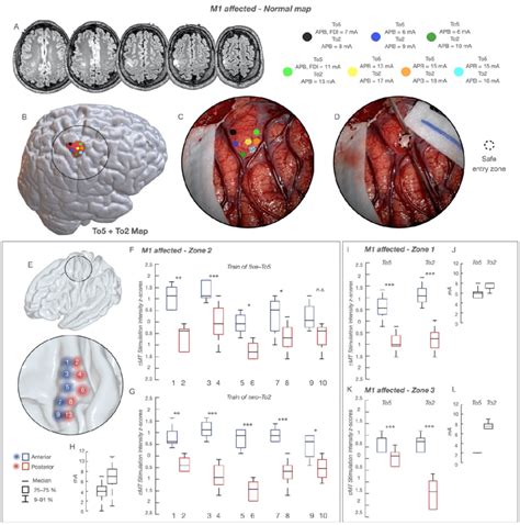 Normal Functional Cortical Map In The Group Of 66 Patients With
