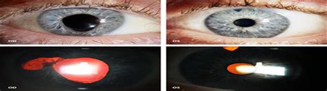 Persistent Mydriasis Following Gonioscopy Assisted Translumi