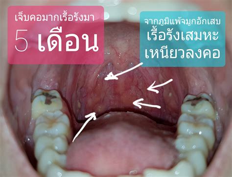 โรคภูมิแพ้จมูก กับ อาการกลิ่นปากและลมหายใจเหม็น 1 ส่วนใหญ่จะผ่านการ