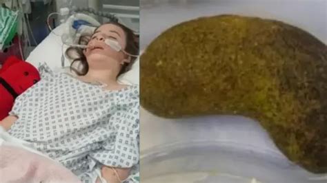 ልዕሊ 15 ሴንቲ ሜትር ዘሰንብድ ዕዅላል ጸጕሪ ካብ ከብዳ ዝተኣለየ ቈልዓ Bbc News ትግርኛ