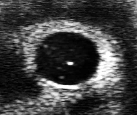 Microcalcification Visibility