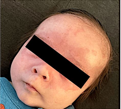 Erythematous Confluent Rash On The Face Predominantly In The