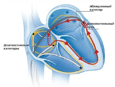 Ectopic Activity Of The Heart Causes
