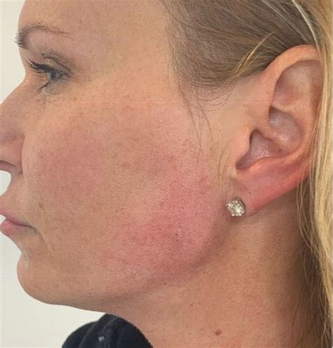 Dermal Fillers Mediface Aesthetics Doncaster Aesthetics