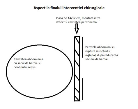 Totul Despre Hernia Inghinala Cauze Simptome Si Tratament Corect Reginamariaro