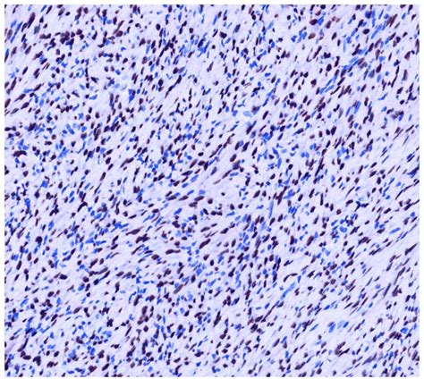 Strongly And Diffusely Positive Staining For Satb2 By Download Scientific Diagram