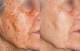 Laser Skin Treatments Winchester The Secret Garden Skin Clinic