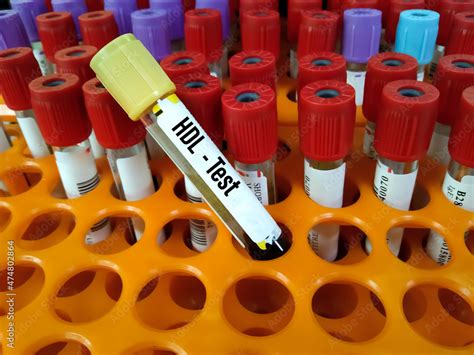 Blood Sample For HDL Cholesterol Test HDL C Good Cholesterol Stock Photo Adobe Stock