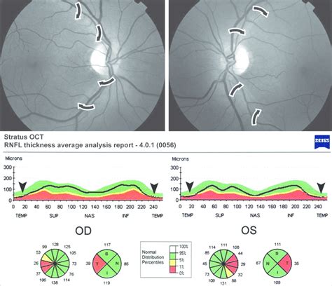 Case 1 Above Fundus Photography Showing Temporal Optic Disc Pallor Download Scientific