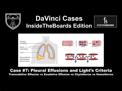 Pleural Effusion Light Criteria