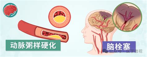 引起脑梗死的原因有哪些？出现偏瘫、肢体麻木、讲话不清等症状，会是脑梗死吗？血管循环血栓