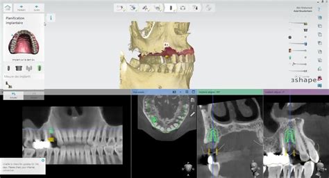 How To Design A Dental Guide With 3shape Moatez Fehri Posted On The Topic Linkedin