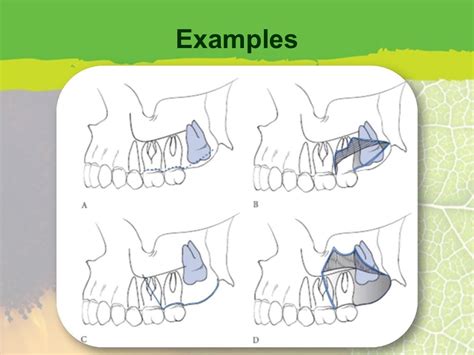 Flap Design For Minor Oral Surgery