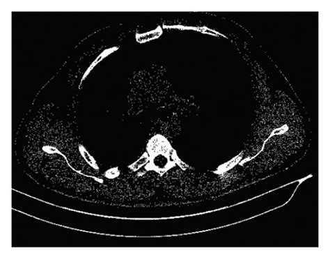 The Comparison Outcomes A Original Ct Image 3 B D Segmentation Download Scientific