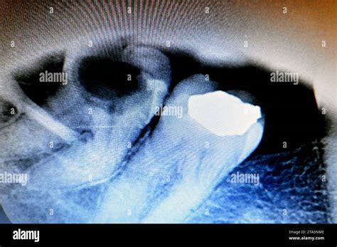 Tooth With Dying Nerve At David Goree Blog