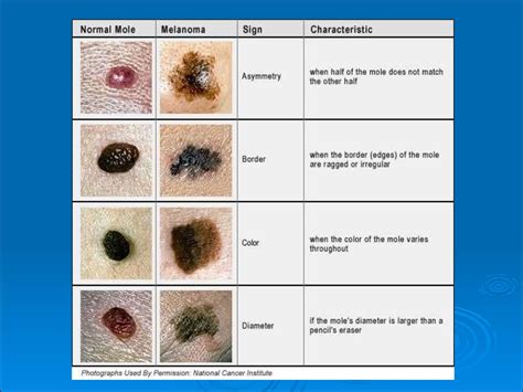 Злоякісні пухлини шкіри презентация онлайн
