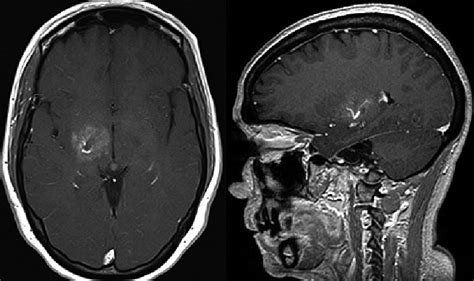 Magnetic Resonance Image In T1 Sequence With Contrast Agent In Axial Download Scientific