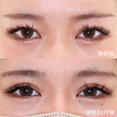 くっきり幅広平行二重！【二重全切開】｜症例写真・ビフォーアフター｜美容整形･美容外科のtaクリニックグループ