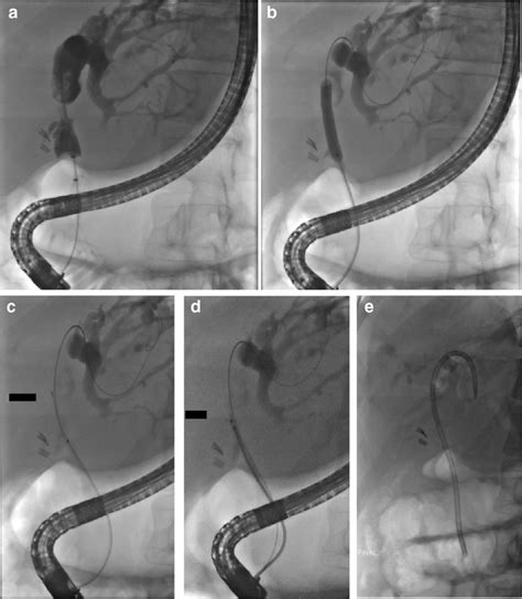 A Cholangiogram Of A Patient With Psc And Severe Refractory Dominant