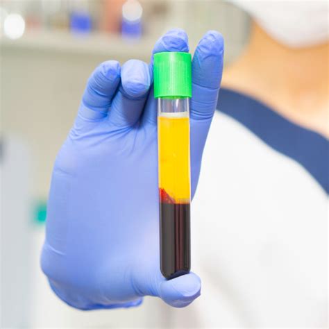 Prp Joint Injection San Diego Oasis Health And Medicine 858 201 3171